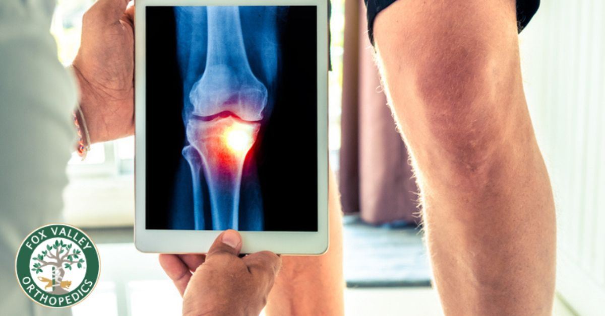 Restoring Knee Stability with the Lemaire Procedure